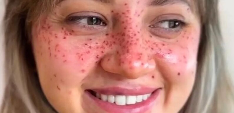Women transform with freckle tattoos – but those bullied are baffled by ...